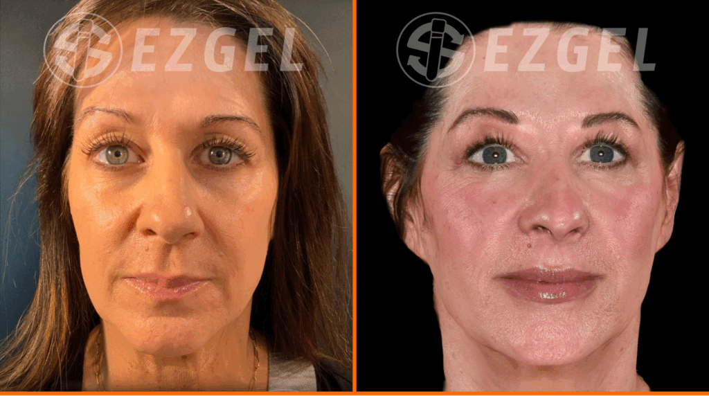 EZ Gel PRF PLATELET-RICH-FIBRIN – Rejuve Anti Aging Medical Spa in Franklin